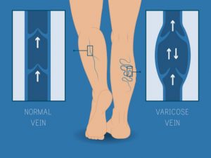 Best Varicose Veins Doctor in Panvel | Dr. Ashish Dhadas