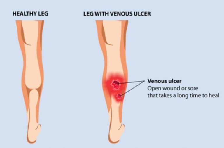 Leg ulcer treatment | varicose veins treatment in Panvel | Surekha ...